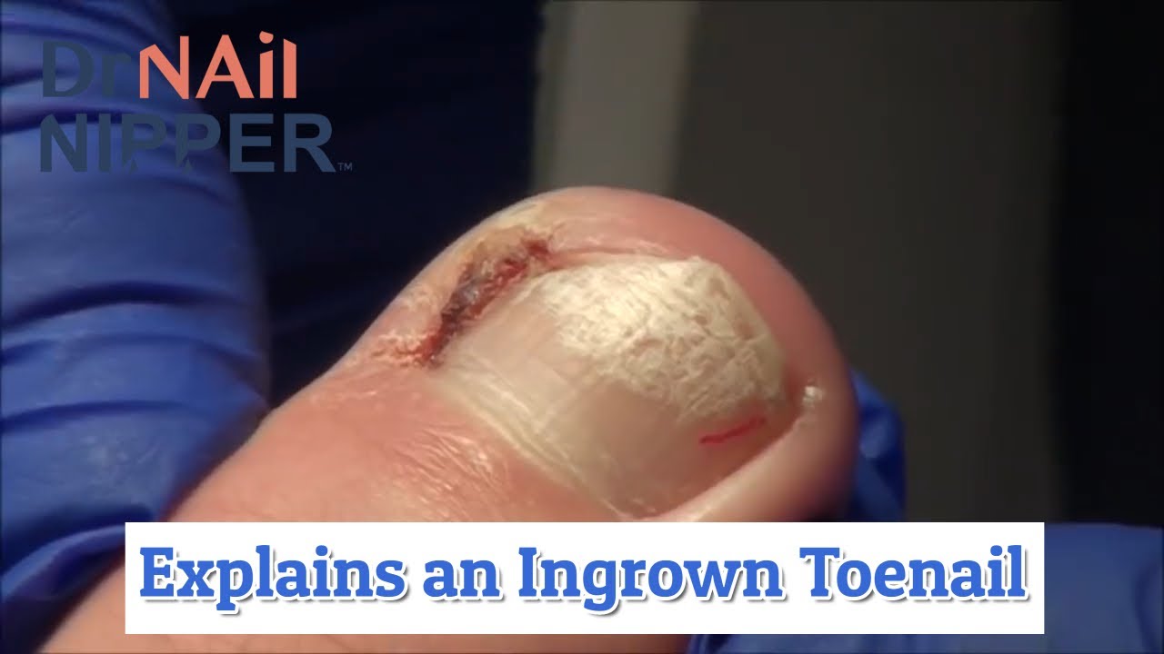 Dr Nail Nipper Explains an Ingrown Toenail [Throwback Thursday Bonus ...