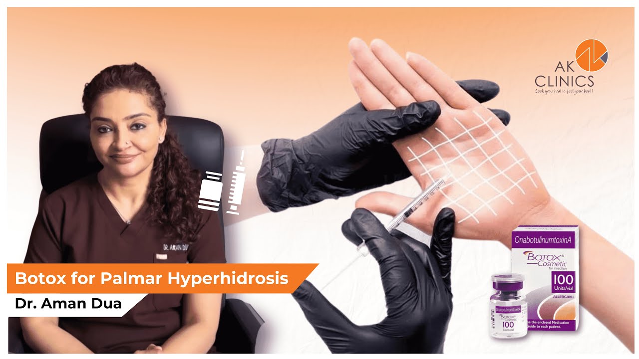 Hand Sweating Treatment with Botox | Hyperhidrosis (Excessive Sweating ...