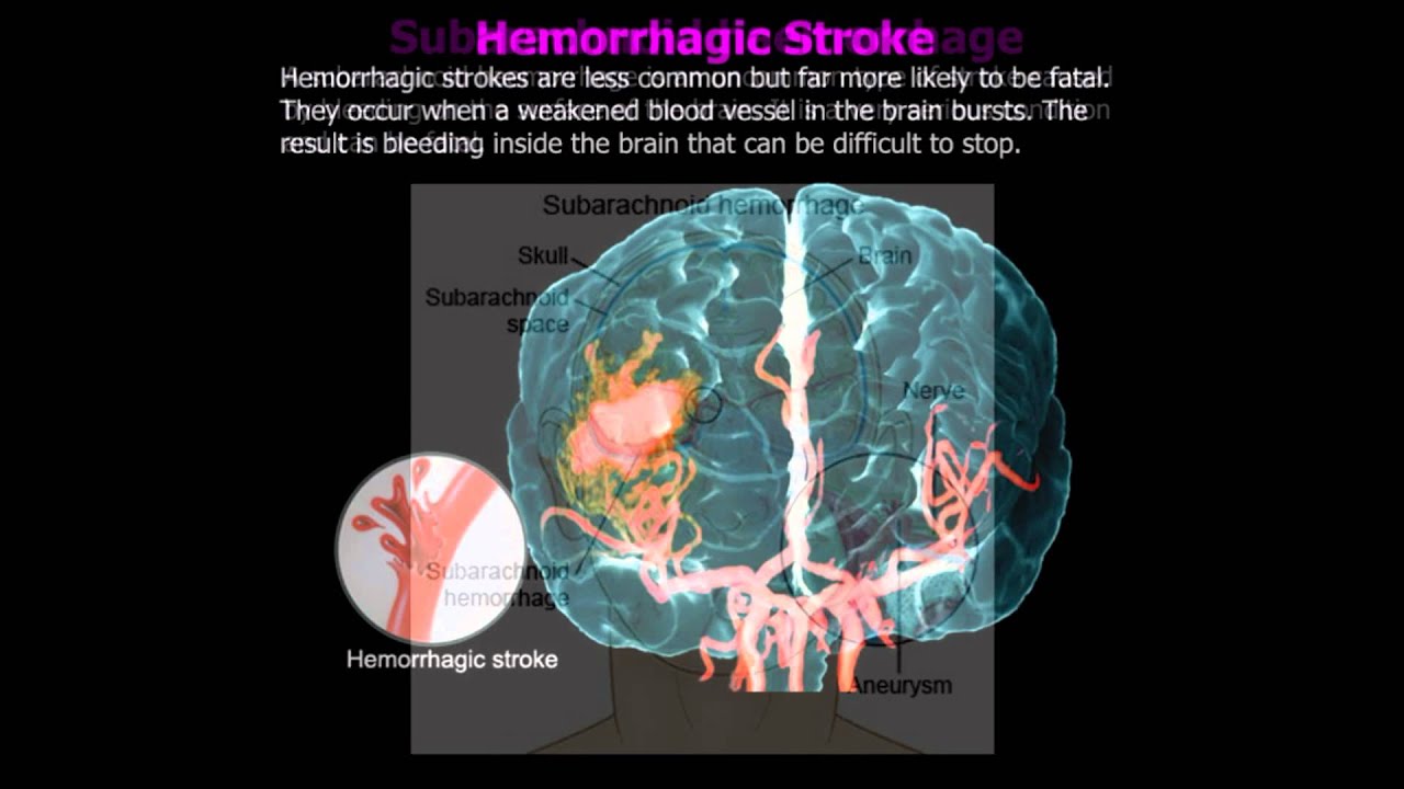 Lupus SLE and STROKE - YouTube