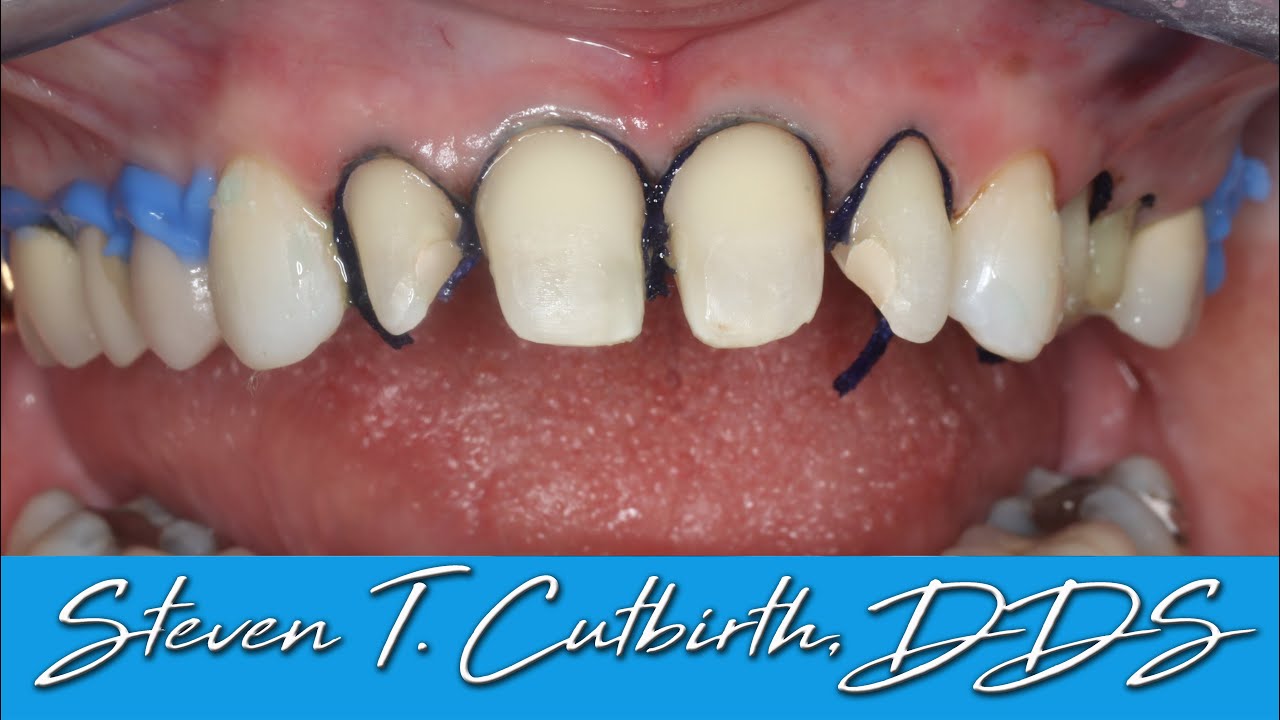 Gingival Retraction Dental Meaning at Henry Hamill blog