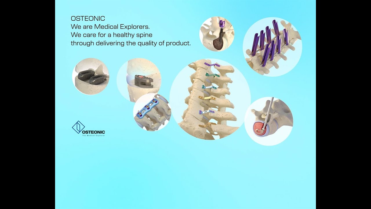 OSTEONIC SPINE PORTFOLIO - YouTube