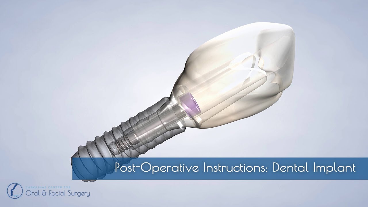 Post-Operative Instructions: Dental Implants - YouTube