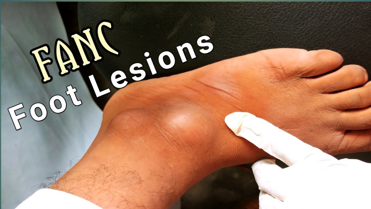 FNAC In The Diagnosis of Foot Lesions - YouTube