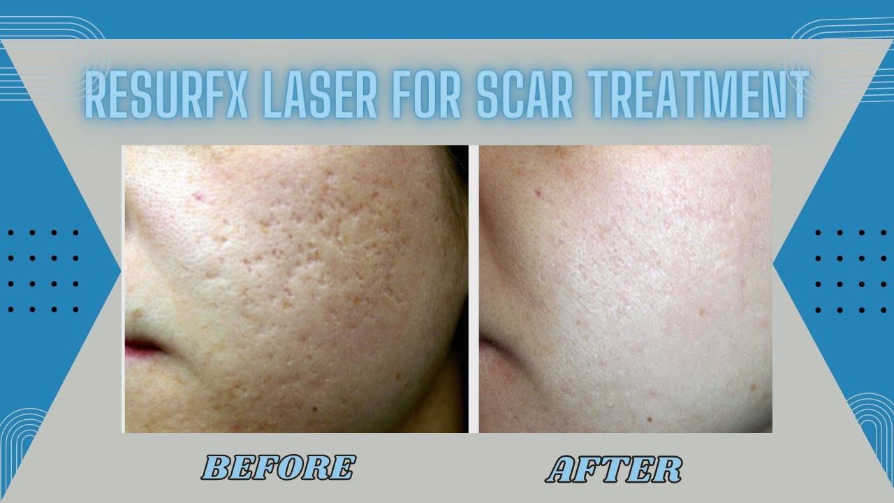 ResurFX LASER FOR SCAR TREATMENT - Dr. Rashmi Rastogi – Fortune Skin ...