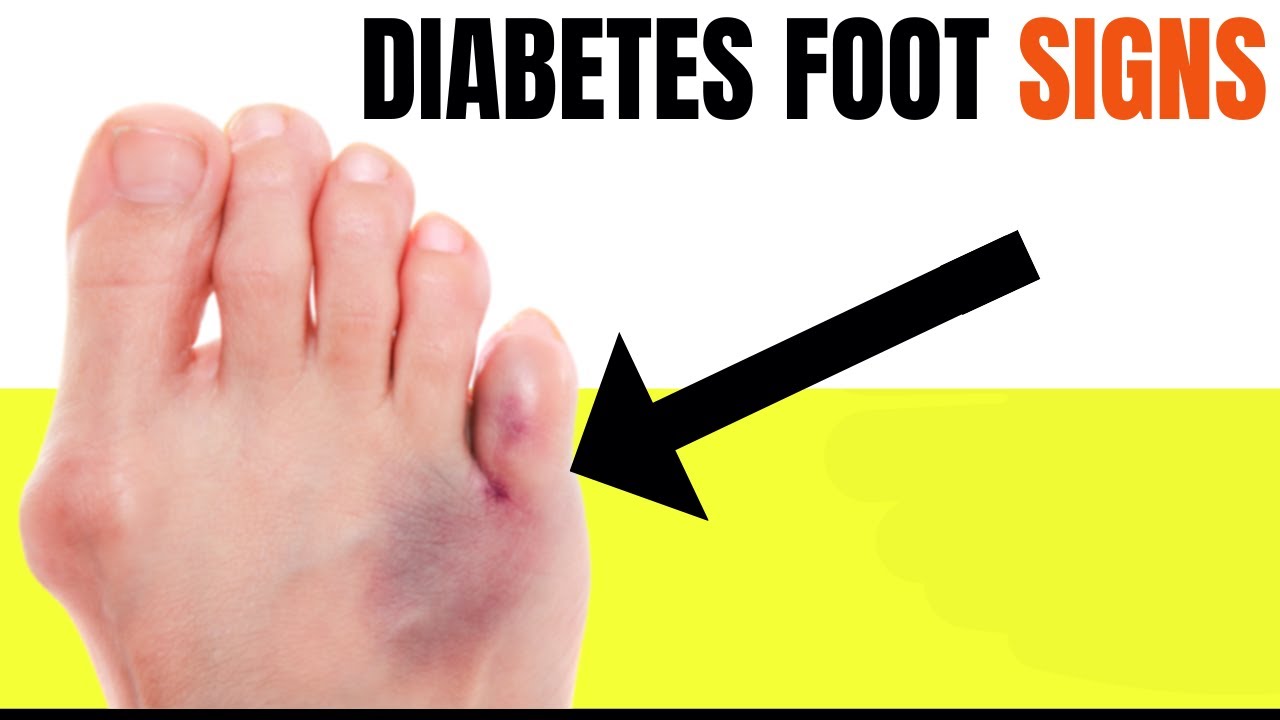 Recognizing 10 signs on your feet about diabetes - YouTube