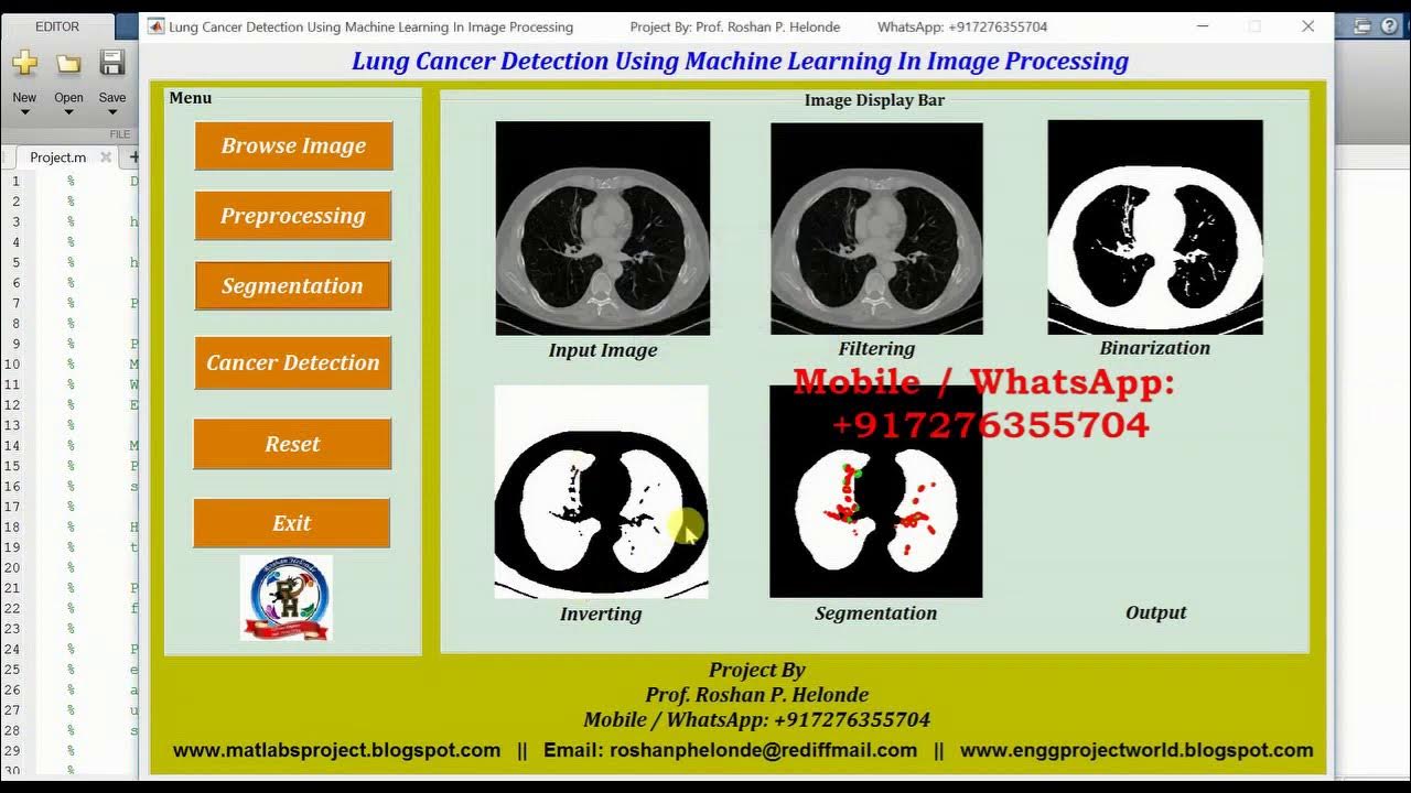 Matlab Code for Lung Cancer Detection Using Support Vector Machine Full ...