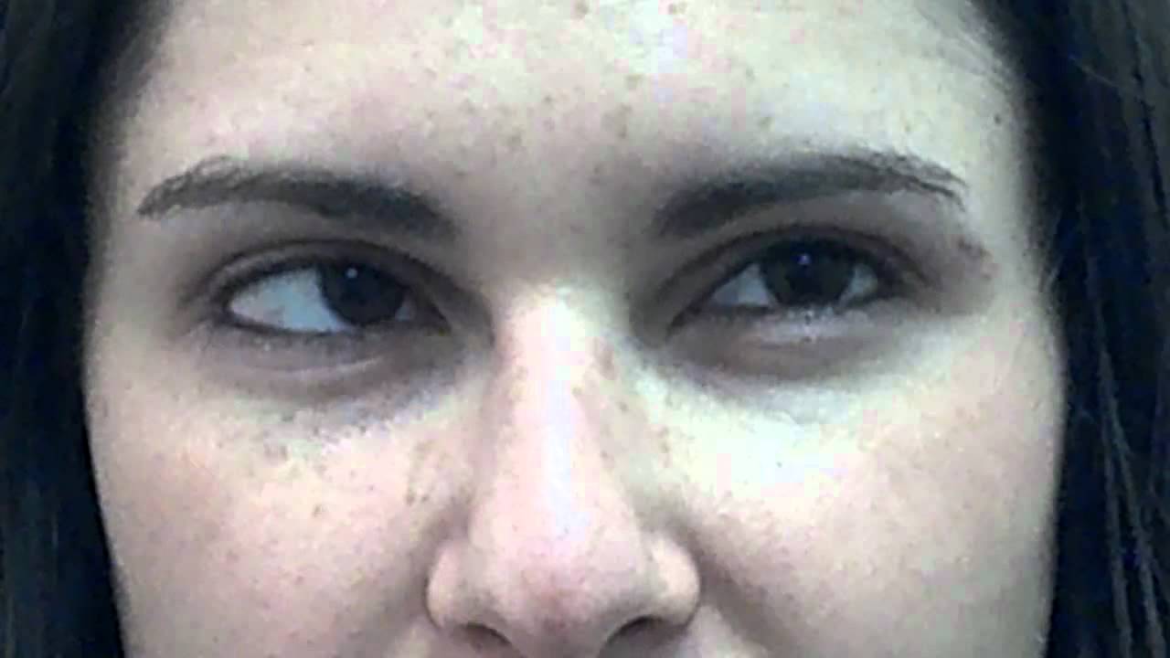 Duane's Syndrome: limited abduction of the left eye can be extended in ...