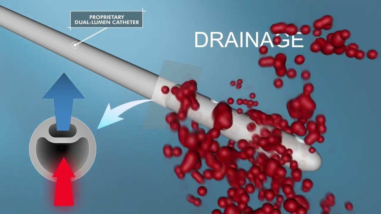 Introducing the Next-Generation IRRAflow System - YouTube