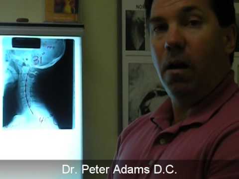 Jacksonville FL Chiropractor Dr. Peter Adams discusses an important ...
