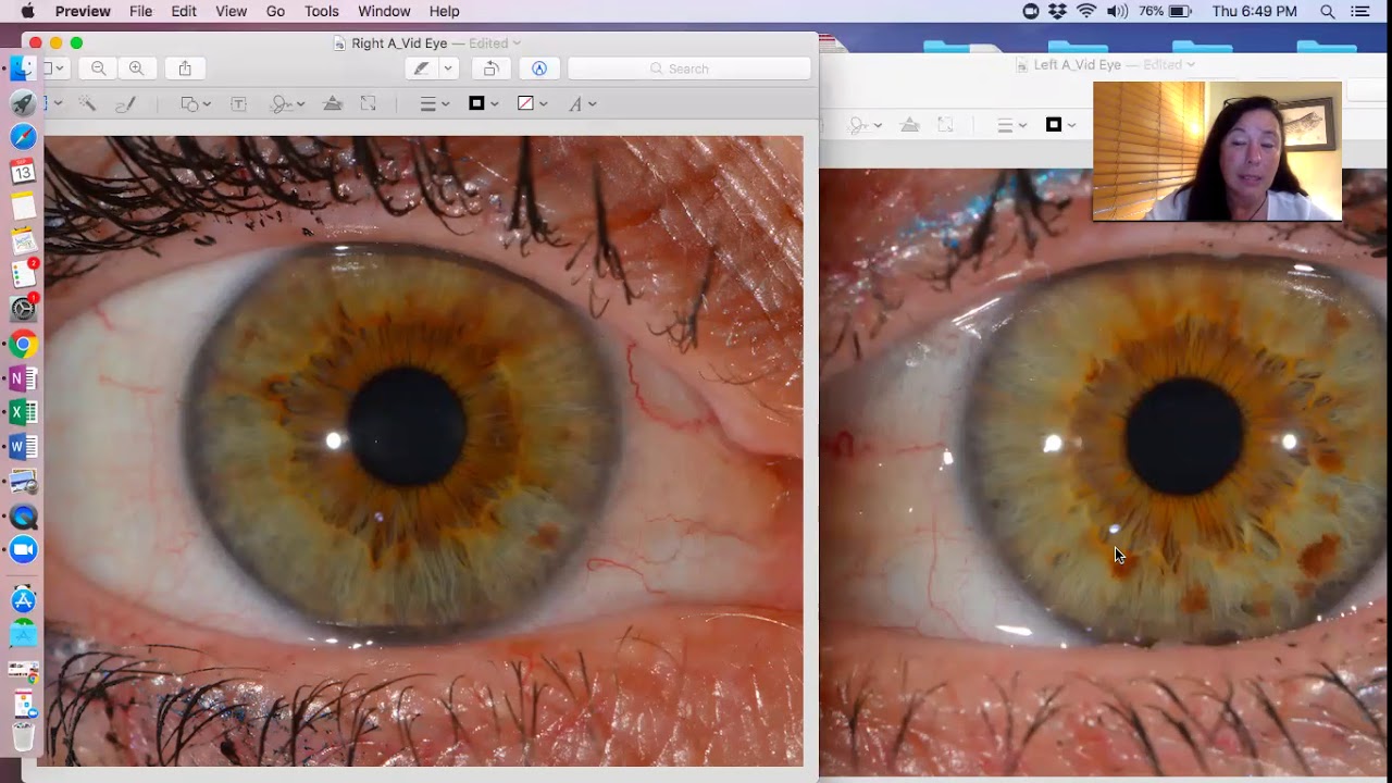 Intro to Irigenics: The difference between Right and Left Eyes - YouTube