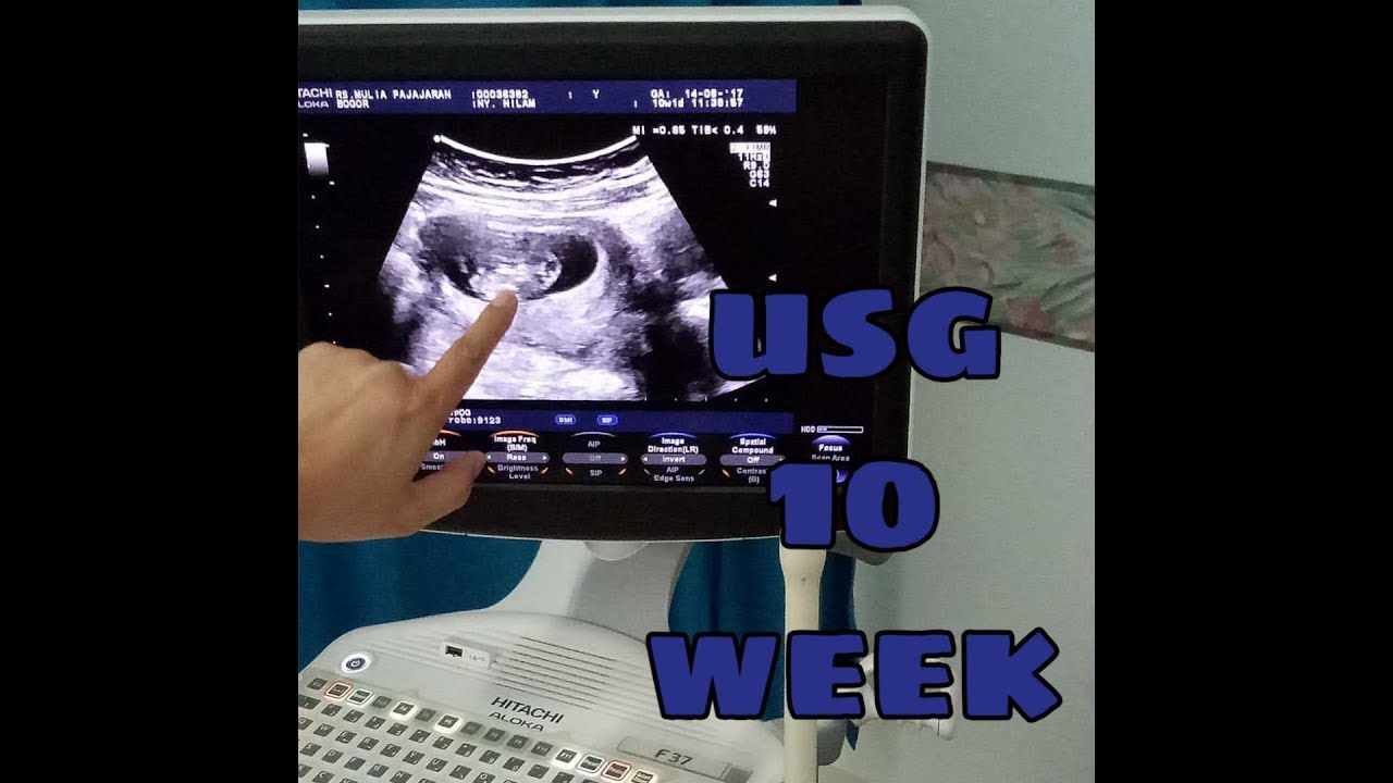 NEMENIN ISTRI USG 8 WEEK PREGNANT - YouTube