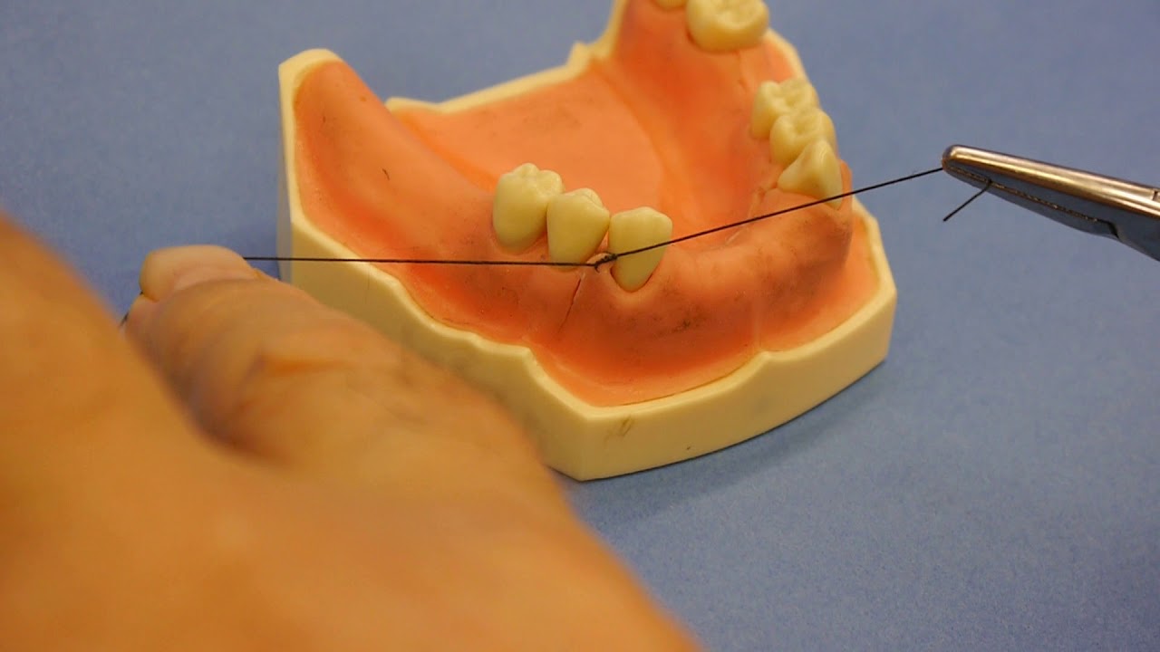 Figure of Eight Suture Labial Approach - YouTube