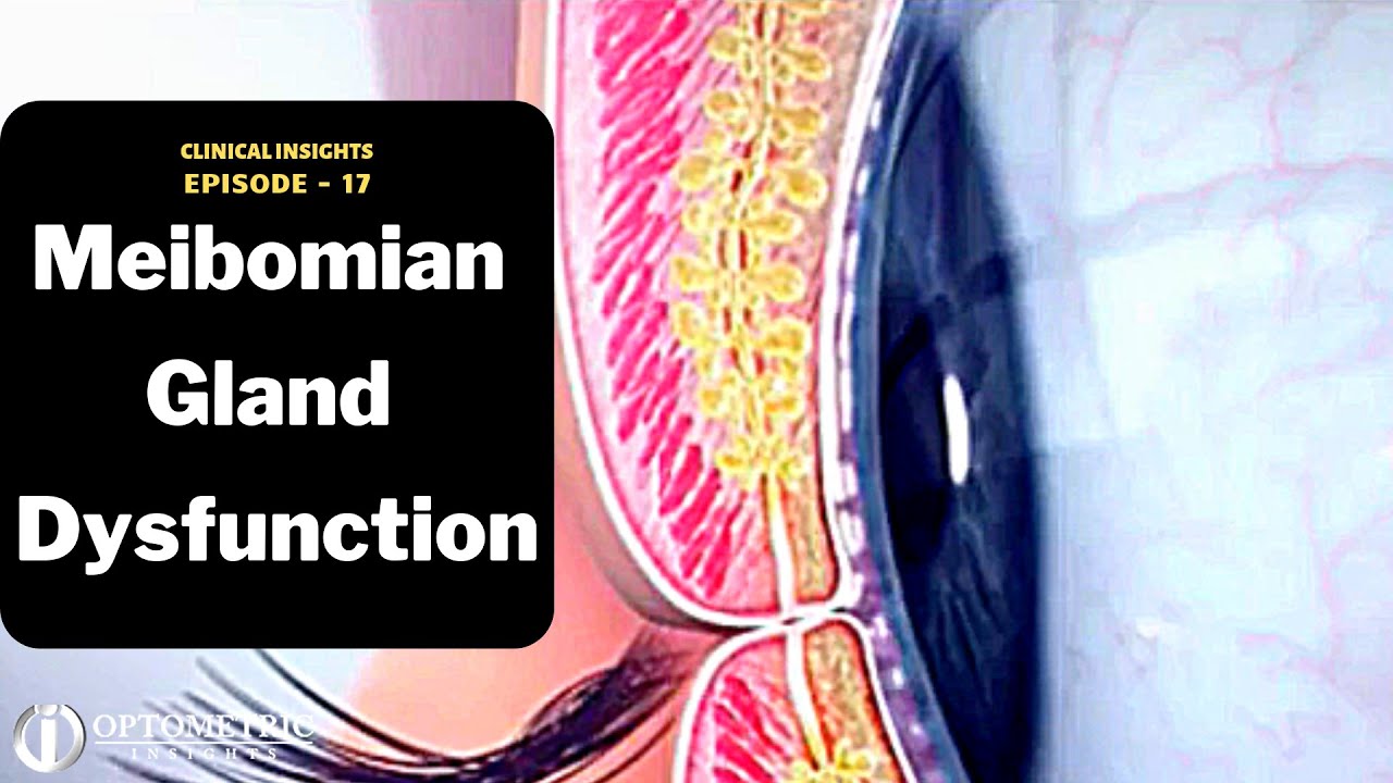 How to Treat MGD - Episode 17 - YouTube