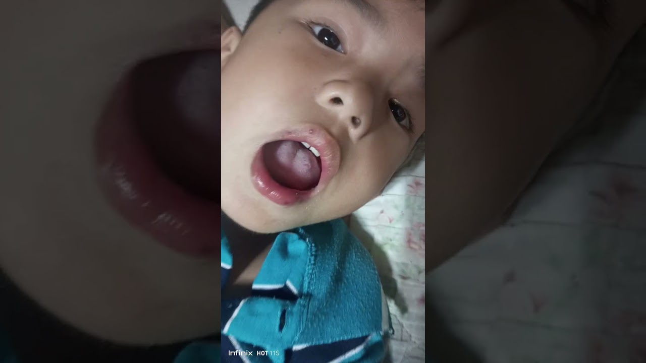 Sintomas ng HFMD/Hand,Foot and Mouth Disease - YouTube