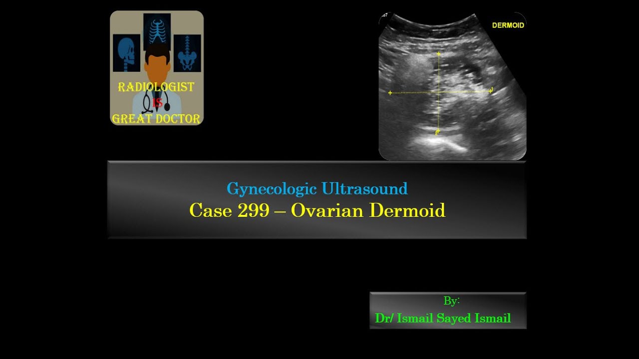 Ultrasound Case 299 - Ovarian Dermoid Cyst - YouTube