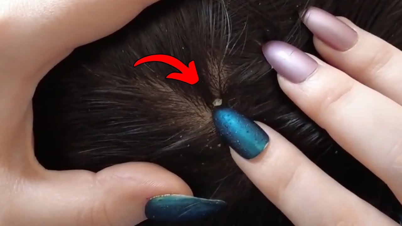 ASMR Scalp Check No Talking ( Zoom ) | Dandruff Scratching | Scalp ...