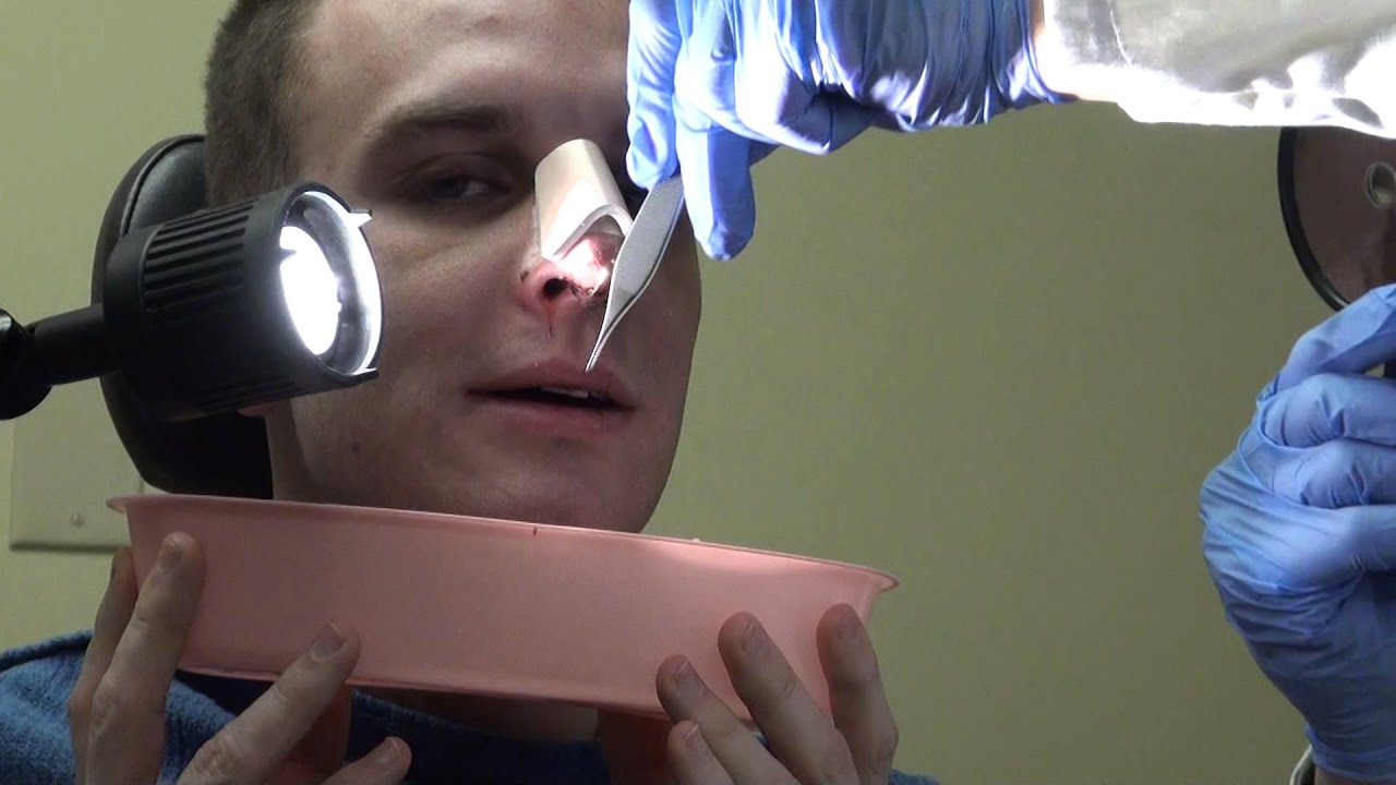 Stent Removal from Septoplasty - YouTube