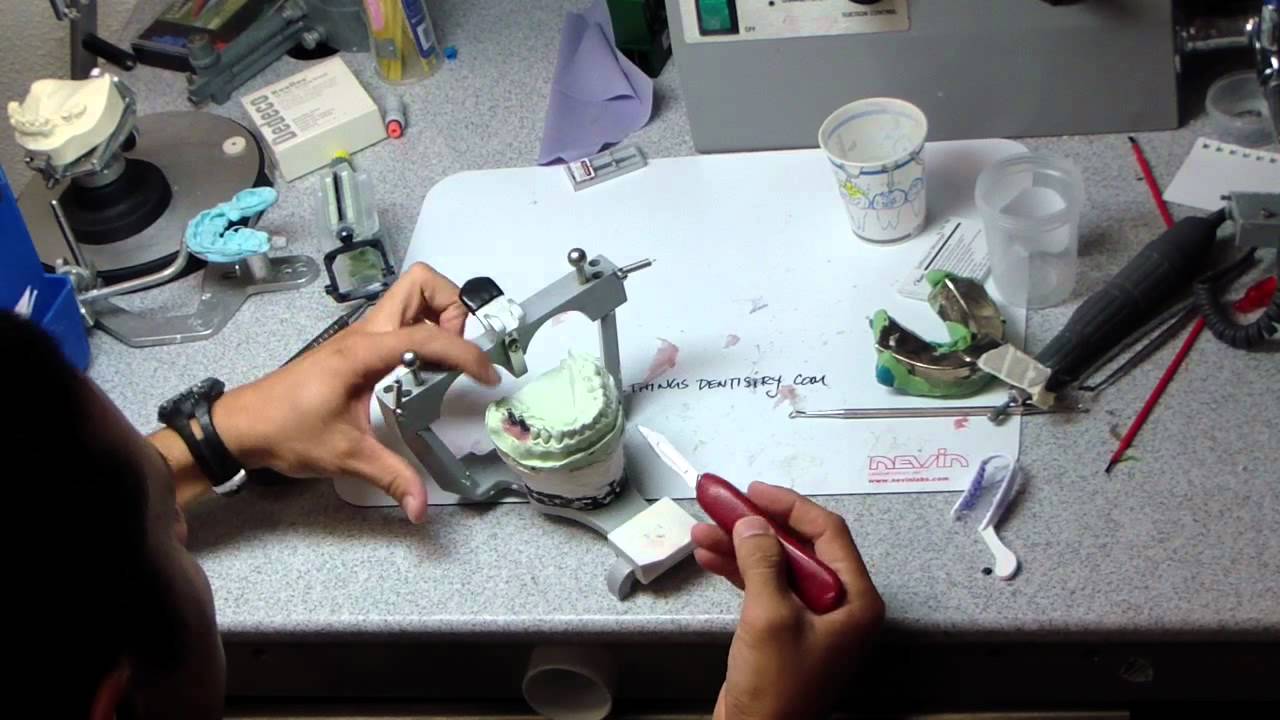 Soft Tissue Moulage back onto cast part 2.MP4 - YouTube