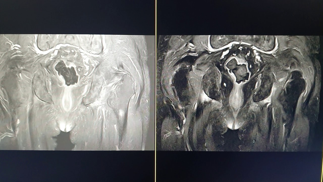Hip MRI contrast view - YouTube