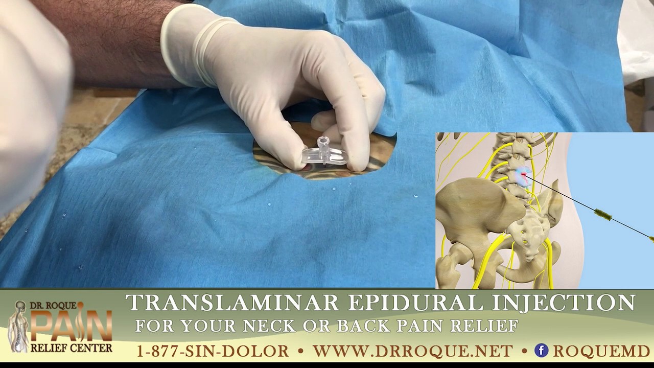 Translaminar Epidural - YouTube