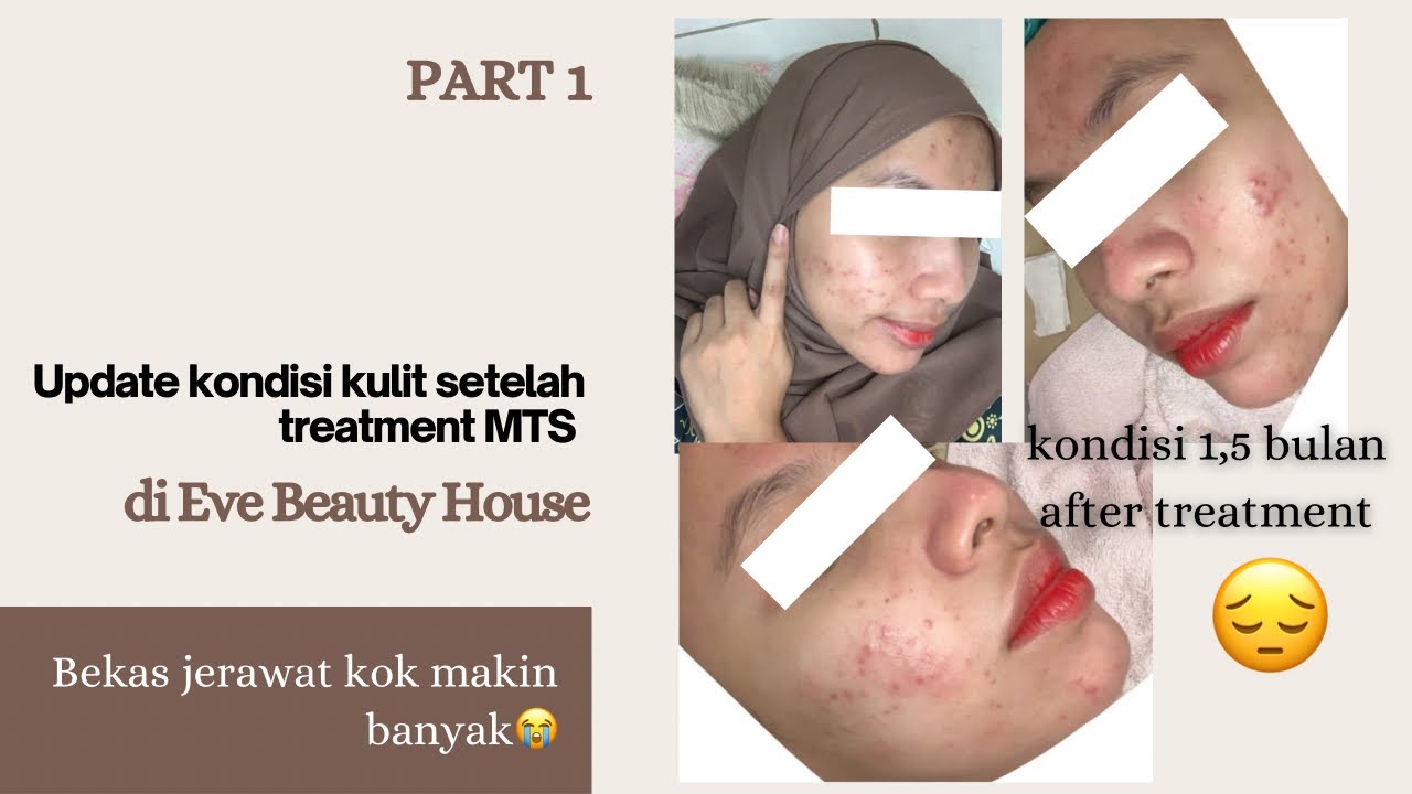 Update kondisi kulit setelah treatment MTS (microneedling therapy ...