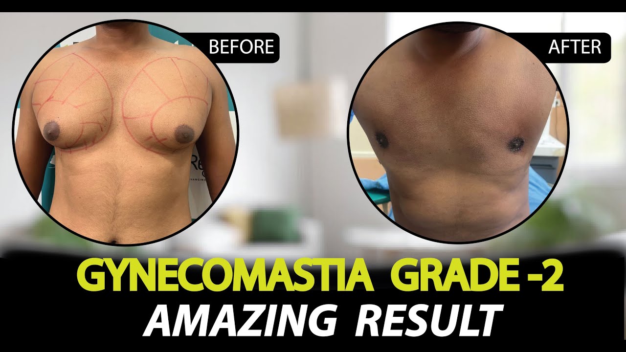 Gynecomastia Grade 2 Surgery in Jaipur | Patient Feedback | Rejuvena ...