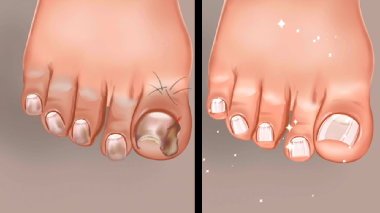 [ASMR] Como Limpar Unhas Cravadas Inflamada - YouTube