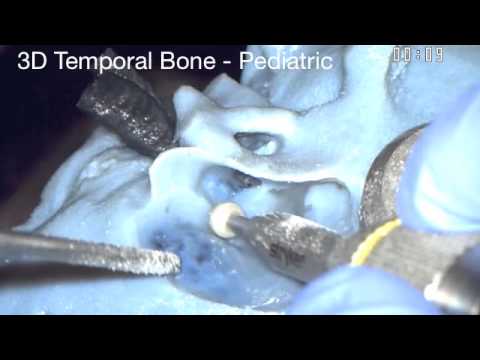 3D Temporal Bone - Pediatric - YouTube
