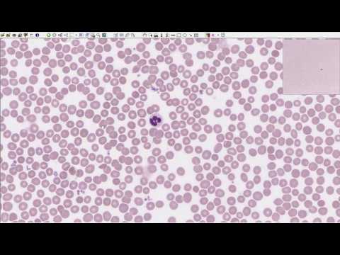 Hematoloji - Giriş, Periferik Yayma ve Kemik İliği