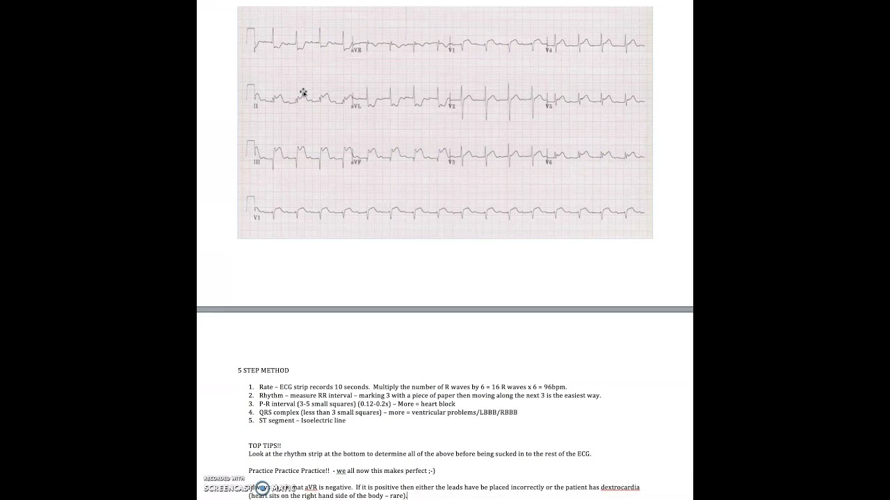 5 Step ECG Interpretation - YouTube