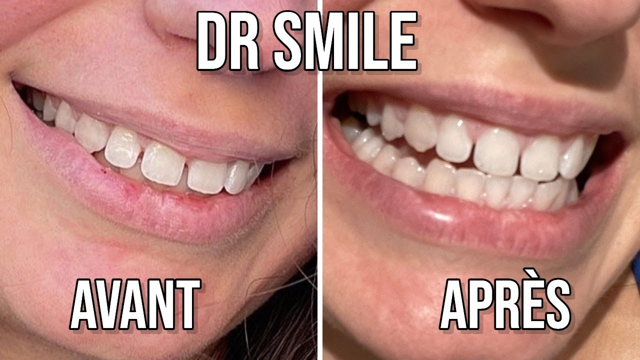 MON AVIS SUR DR SMILE EN MILIEU DE TRAITEMENT - YouTube