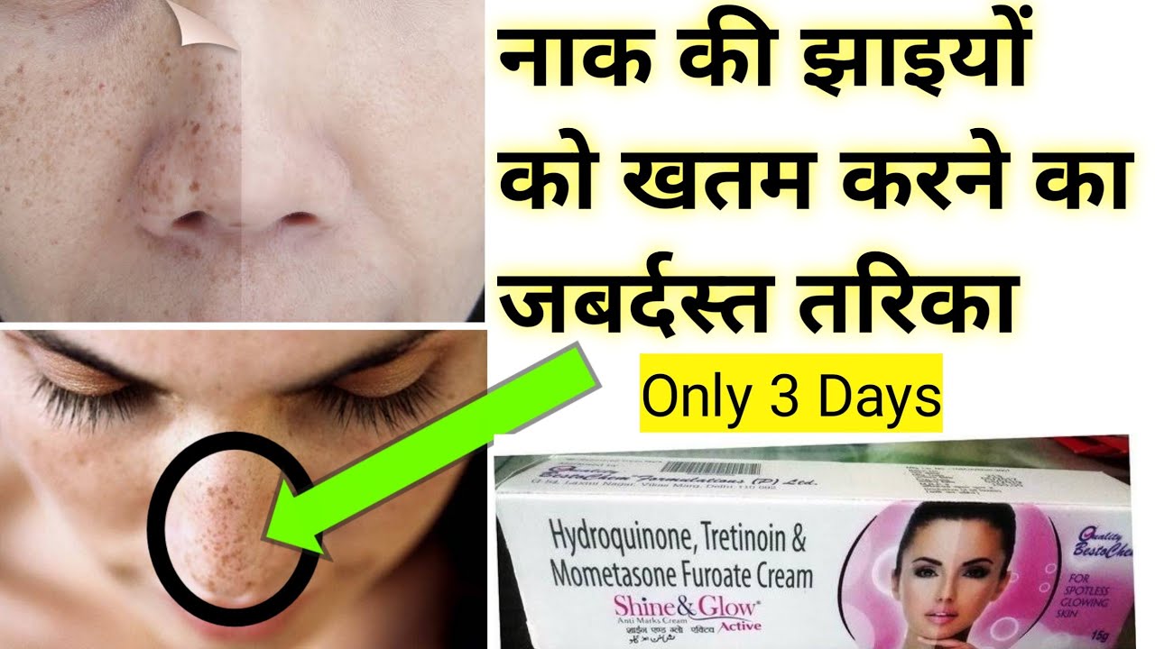 नाक की झाइयों को खतम करने का जबर्दस्त तरिका | Nose Pigmentation ...