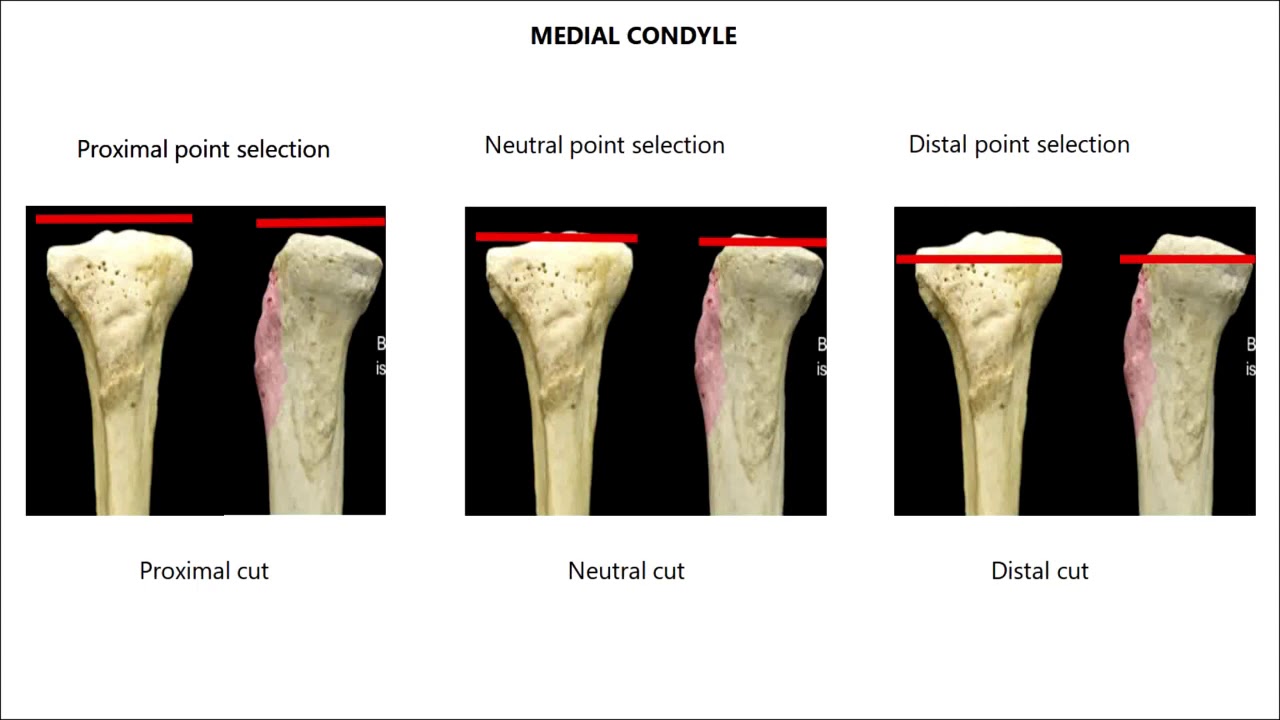 Tibia Landmark Selection for Kne3wiz - YouTube