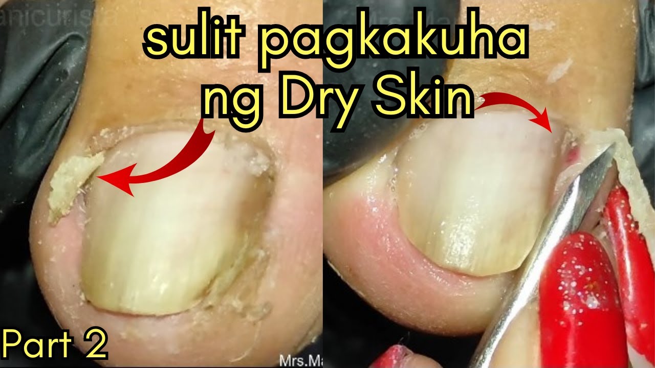 Vlog 794|Dry Skin/Ingrown Removal| PEDICURE 694 - YouTube