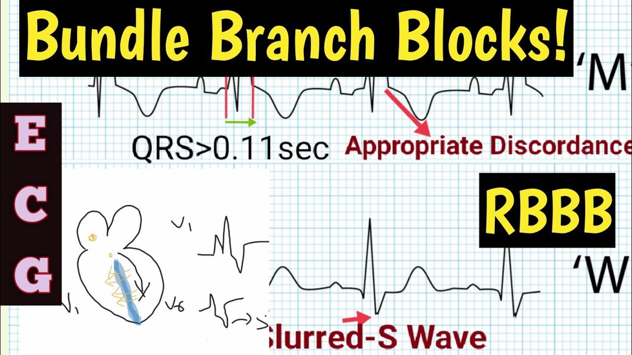 BUNDLE BRANCH BLOCKS ECG INTERPRETATION I RIGHT BUNDLE BRANCH BLOCK ...
