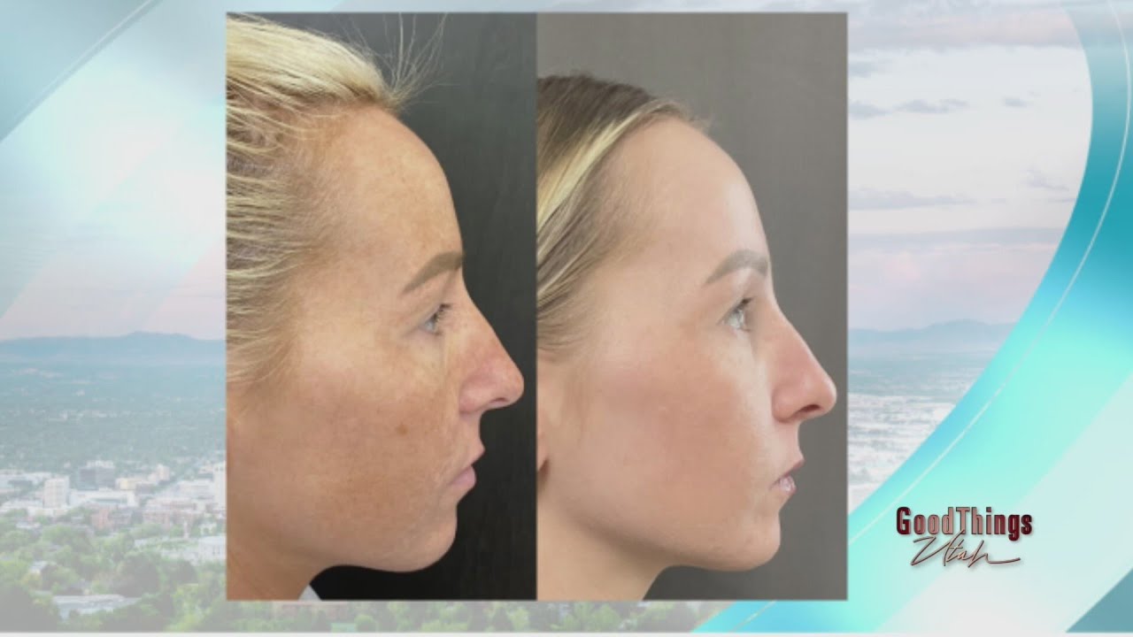 Utah Facial Plastics: Laser resurfacing & what you need to know - YouTube