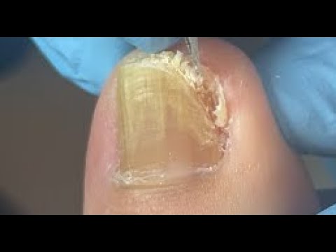 Severe fungus has made nails 4 times thicker - YouTube