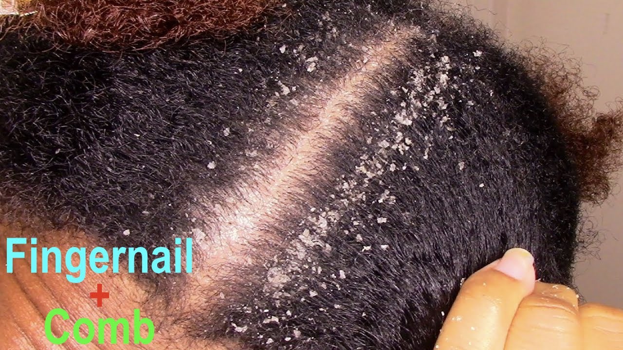 Both Fingernail Scratching & Comb Picking #Frostedflakes # ...