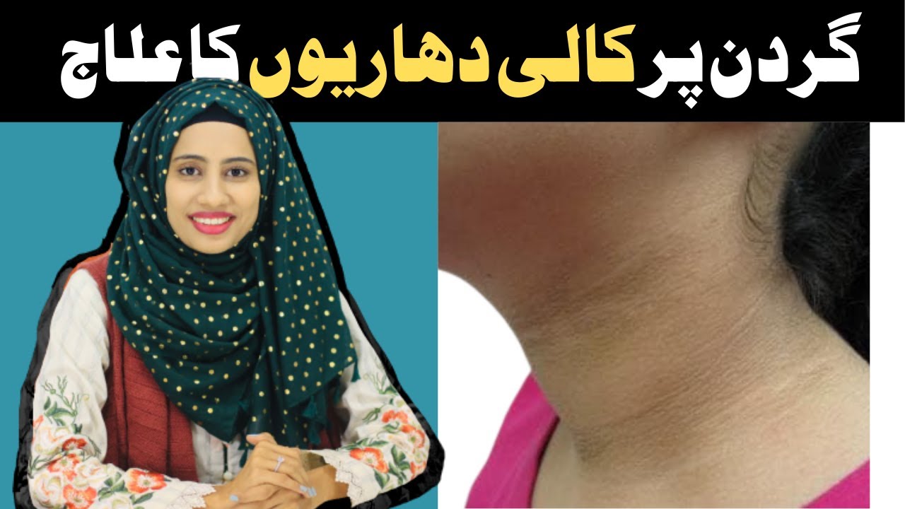 Reason Of Black Lines On Neck Treatment Of Insulin Resistance reason-of-black-lines-on-neck-treatment-of-insulin-resistance