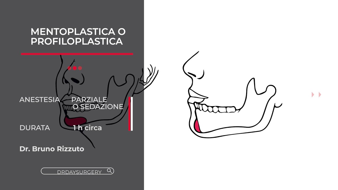 Mentoplastica o Profiloplastica - Ridefinizione delle forme del mento ...