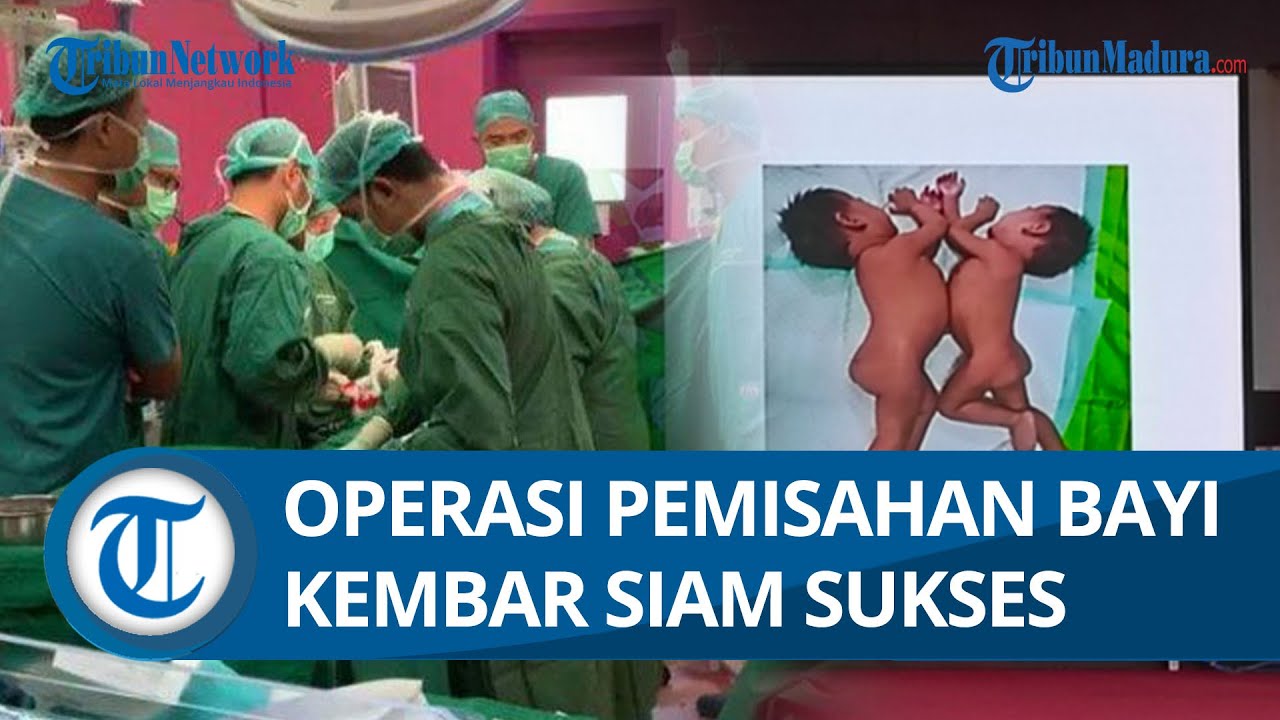 ALHAMDULILLAH, Operasi Pemisahan Bayi Kembar Siam di RS Saiful Anwar Malang Sukses Besar - YouTube