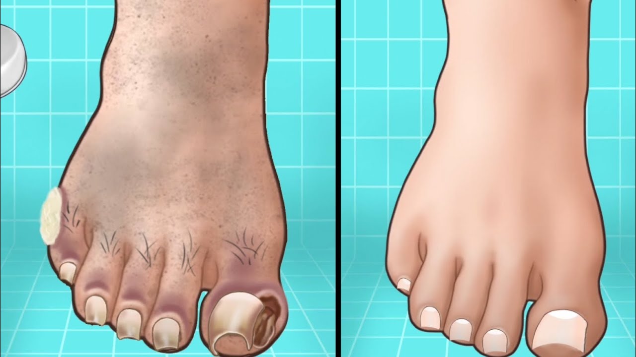 ASMR Foot Remove || Surgery to Remove Larg Plantar Animation Foot ...