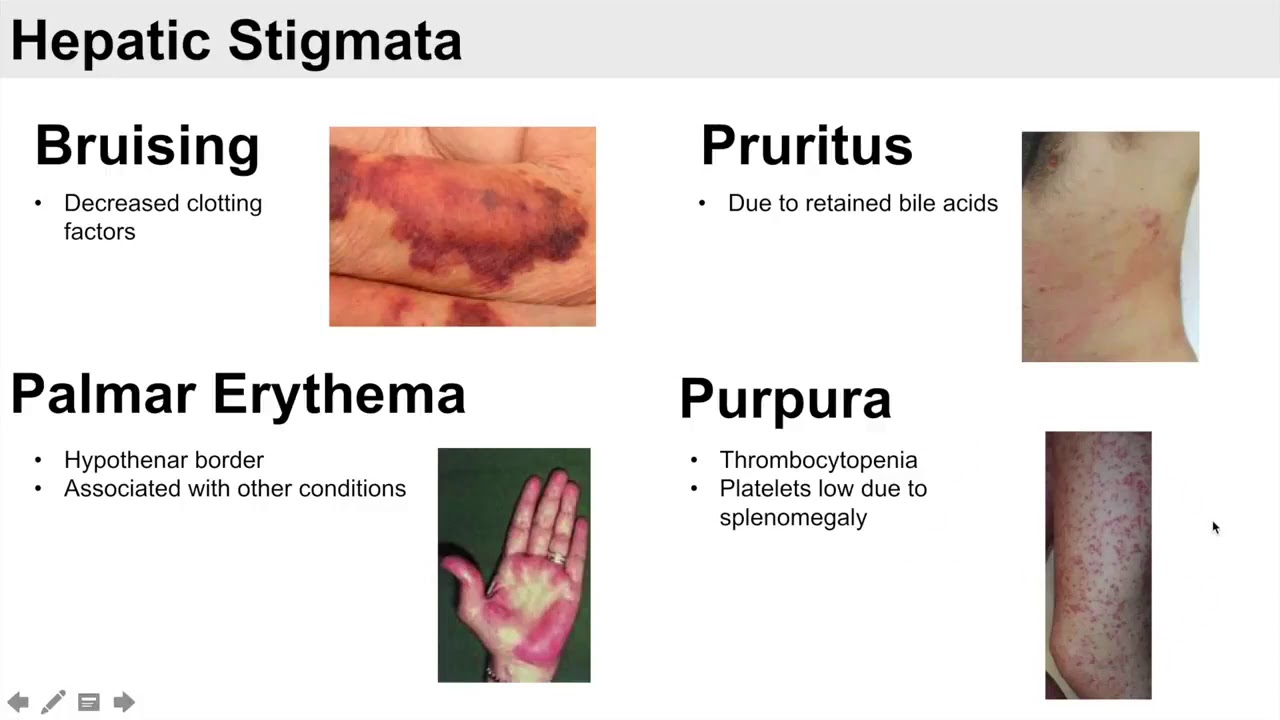 Liver Disease Signs & Symptoms ex gynecomastia, bruising Hepatic ...