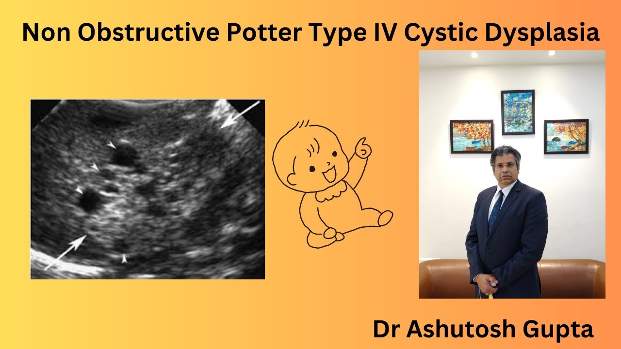 Fetal Non Obstructive Potter Type IV Cystic Dysplasia and Management ...