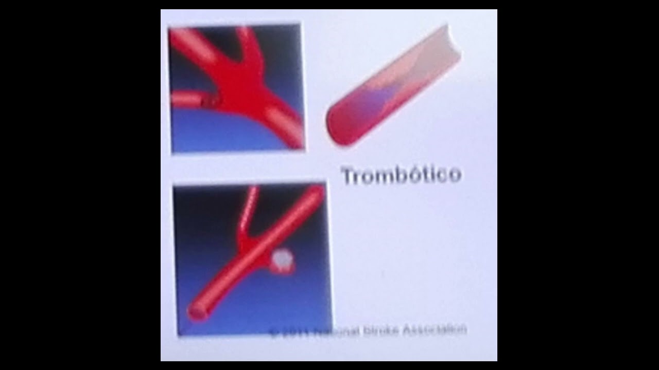 Lo básico del acv - YouTube