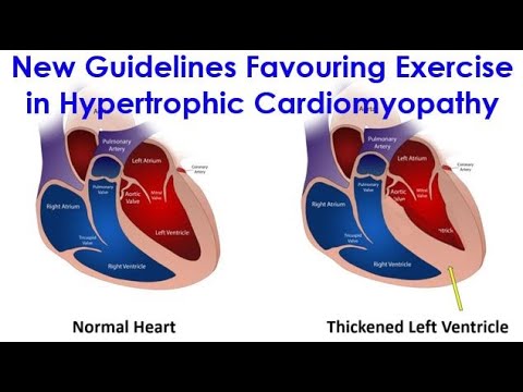 New Guidelines Favouring Exercise in Hypertrophic Cardiomyopathy - YouTube