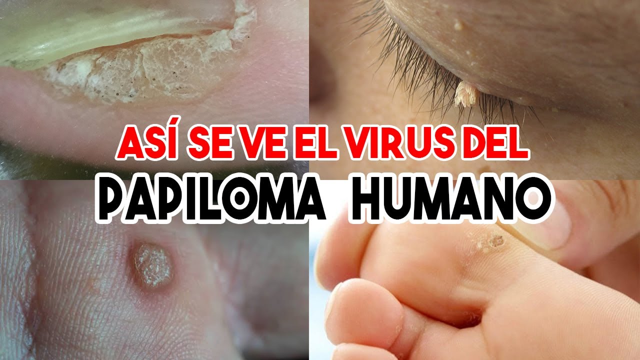 Verrugas Planas Hpv Tratamento E Remoção De Verrugas E Hpv Kit2