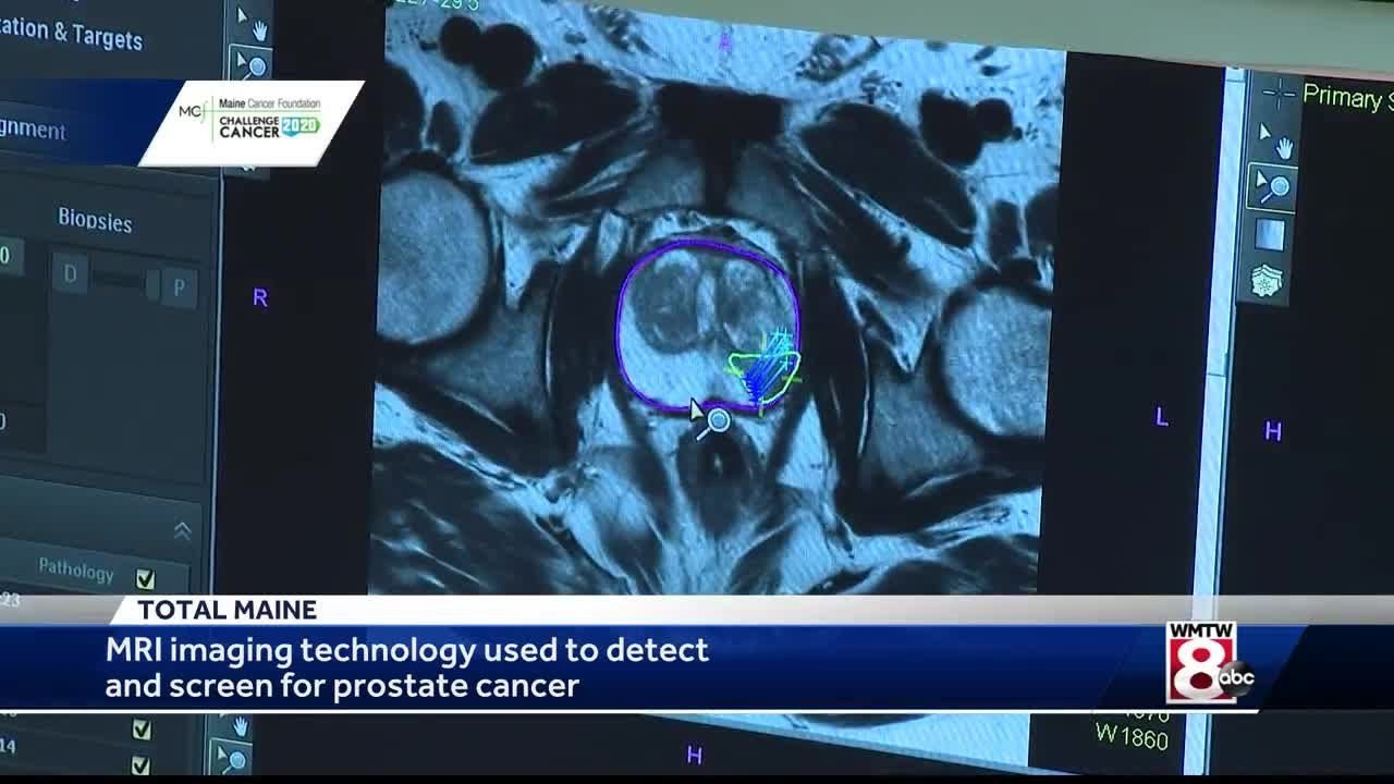 MRI technology used to detect and screen for prostate cancer - YouTube