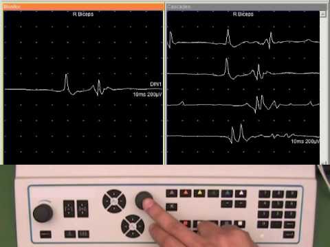 21. UltraPro First Generation Hardware - Needle EMG - YouTube