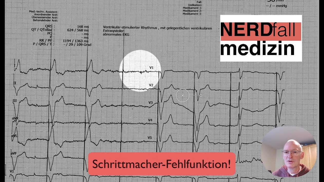 Lagebestimmung Ekg | Themenwoche EKG: Lagebestimmung mittels ...